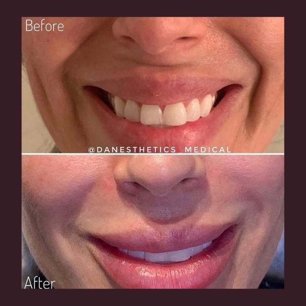 How to Get Rid of Smile Lines aka Nasolabial Folds